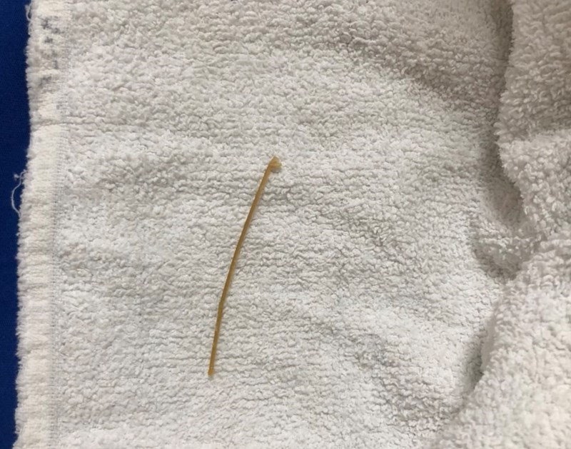 Gắp dị vật tăm dài 6cm trong tá tràng bé trai 3 tuổi