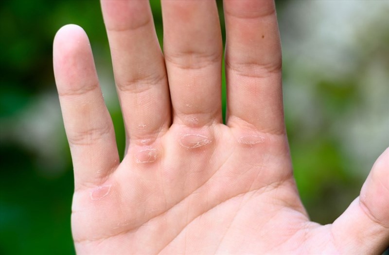 Mẹo loại bỏ vết chai tay đơn giản và hiệu quả