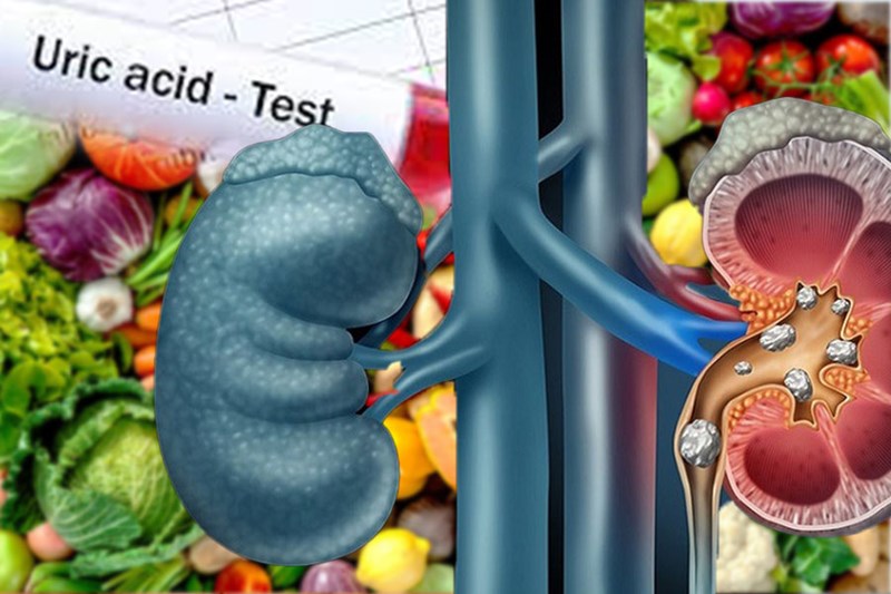 Những cách tự nhiên để kiểm soát nồng độ axit uric trong cơ thể