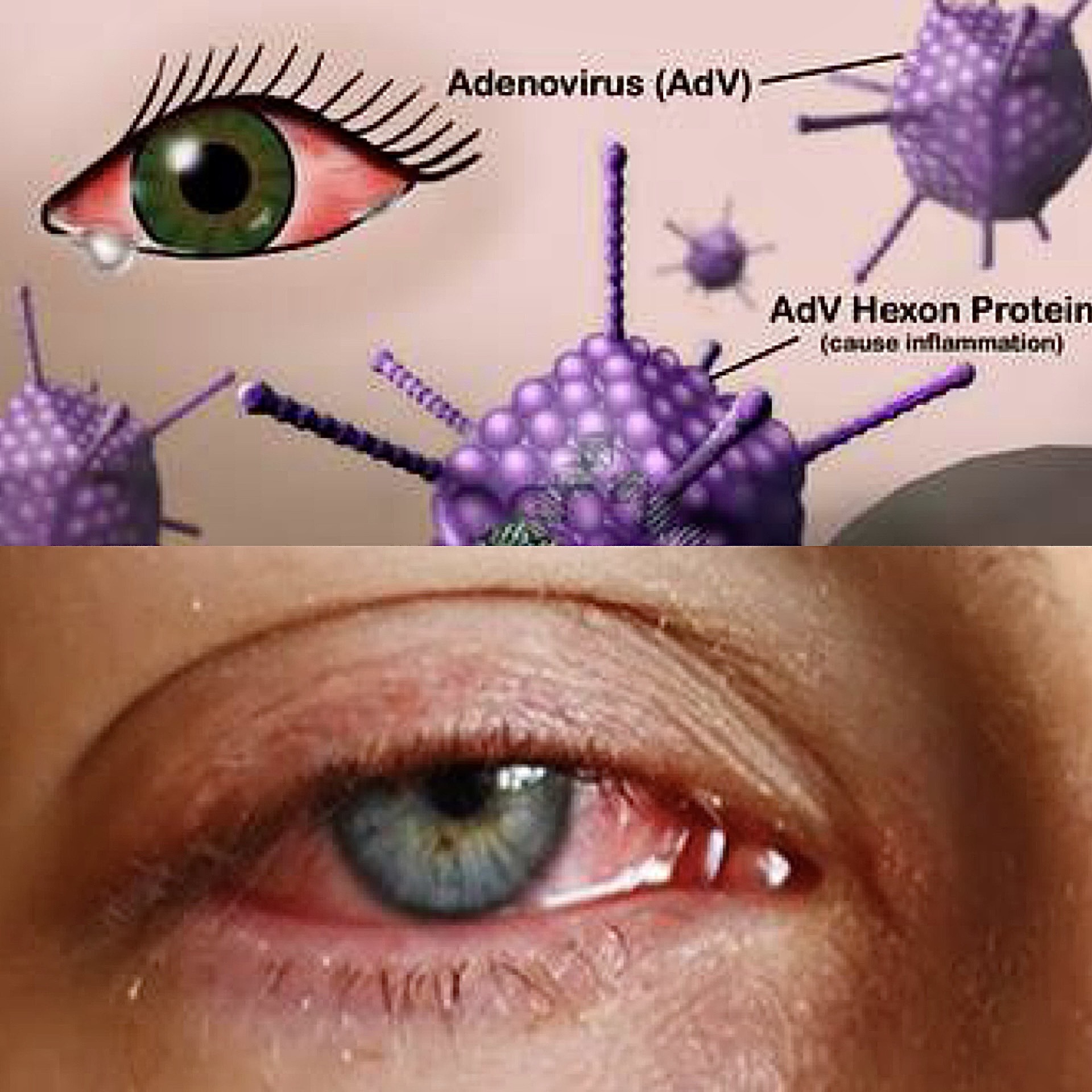 Dịch đau mắt đỏ