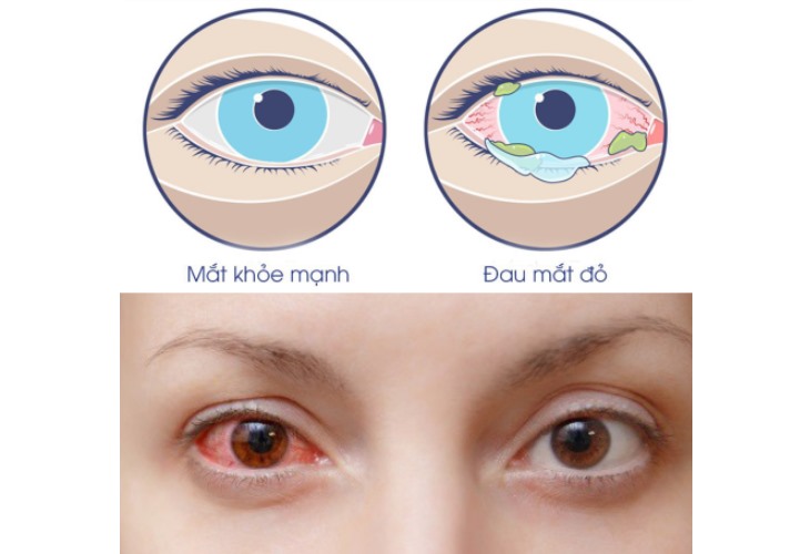 100 ca khám mắt có 30 ca bị đau mắt đỏ