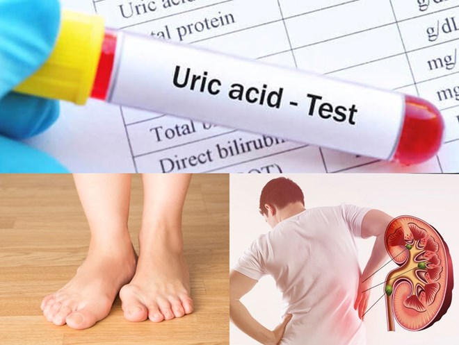 Loại hạt giúp giảm nồng độ axit uric trong cơ thể