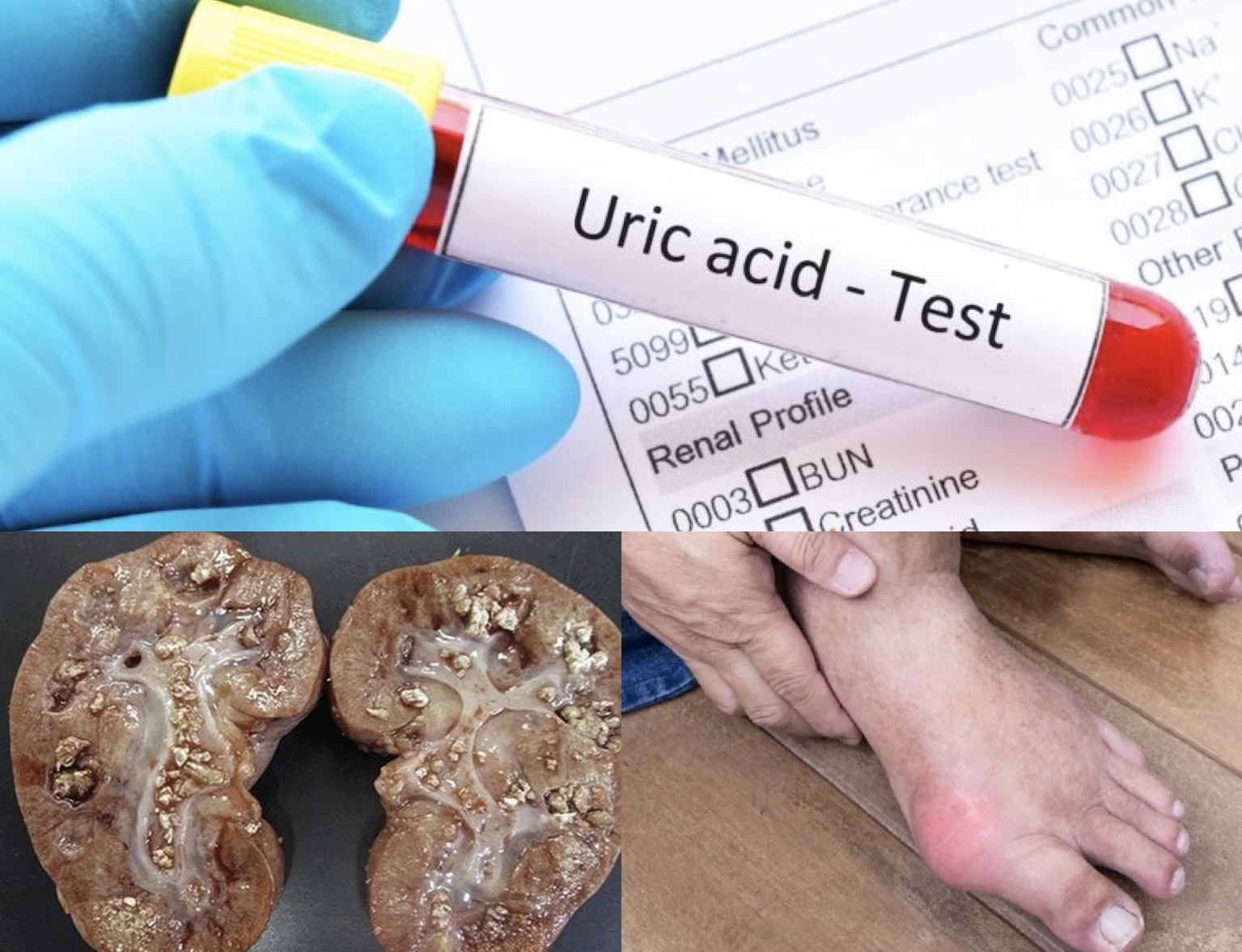 Lý do cần kiểm soát nồng độ axit uric, đặc biệt trong dịpTết