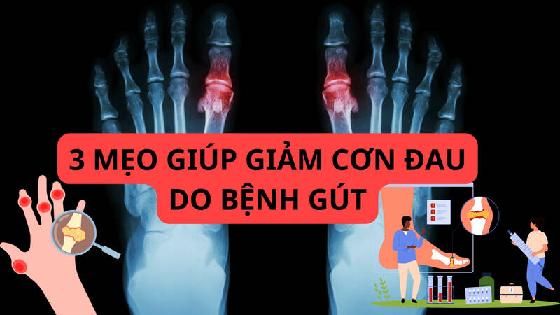 3 mẹo giúp giảm cơn đau do bệnh gút