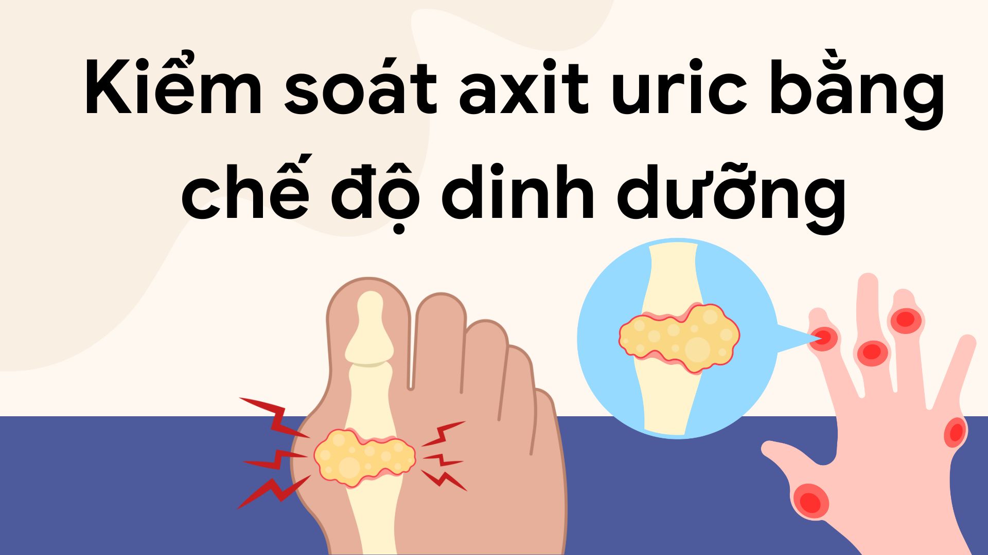 Mẹo nhỏ khi ăn uống giúp kiểm soát axit uric cao